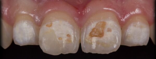 Hypomineralization of Enamel: Diagnosis and Treatment