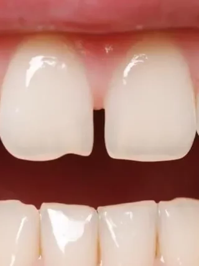 Gap Between The Teeth (Diastema): 3 Most Common Reasons - World of ...