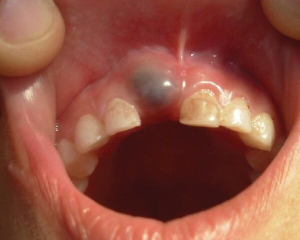 Quiste de erupción dental: 2 síntomas para su tratamiento
