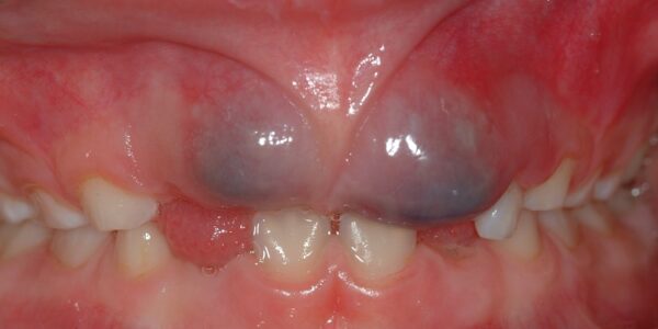 What is an Eruption Cyst? (3 Preventive Measures For It)