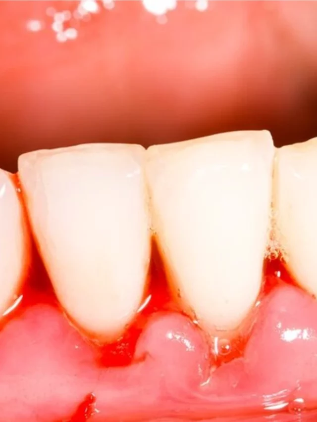 The 4 Stages of Gum Disease: Signs, Symptoms, and Treatment - World of ...