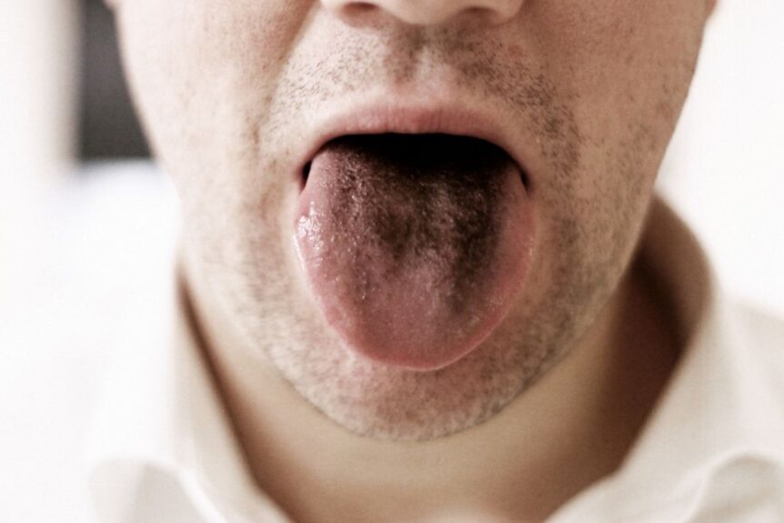 Tratamiento Lengua Negra World Of Dentistry
