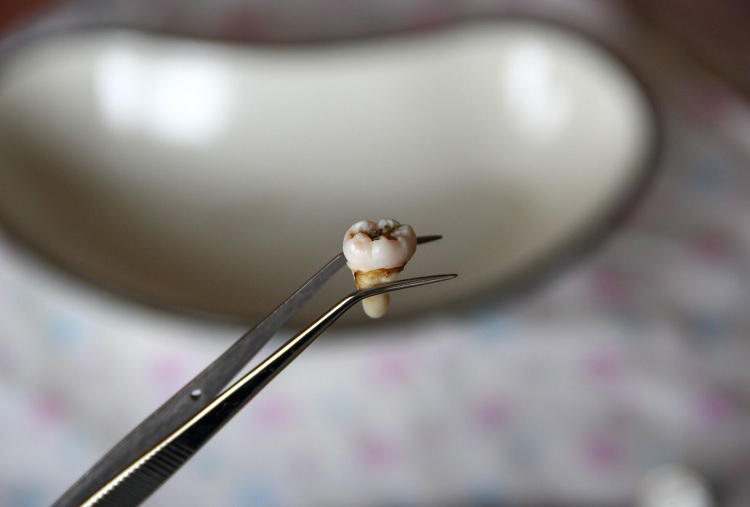 Removing Food Stuck in Wisdom Tooth Hole (5 Effective Ways)