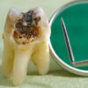Internal Tooth Resorption: 7 Definitive Symptoms To Look For