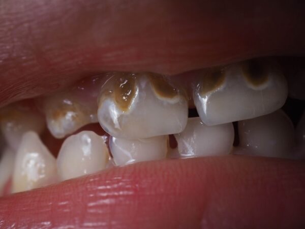 Signs and Symptoms of Enamel Erosion: 8 Tips To Prevent