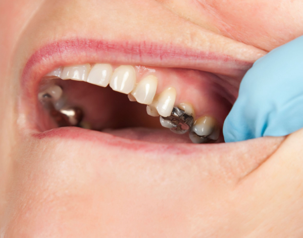 Tooth Infection Spreading to the Bone: 6 Definitive Causes