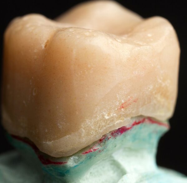 What is Dental Resorption? 5 Possible Important Causes