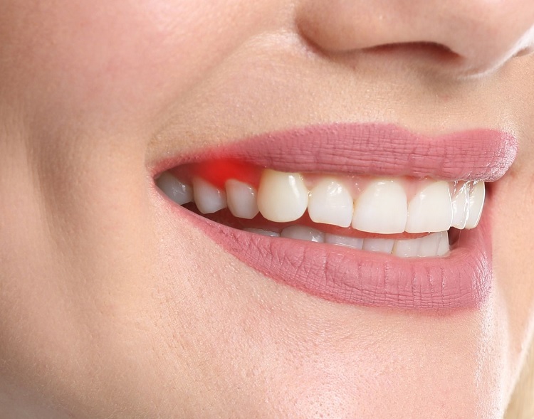 How to Drain a Tooth Abscess at Home? 5 Surefire Ways