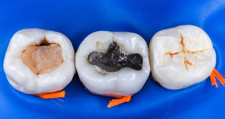 Composite Fillings: 4 Common Advantages and Disadvantages