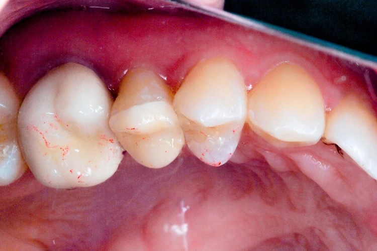 Tooth Filling Fell Out: 5 Important Reasons to see a Dentist