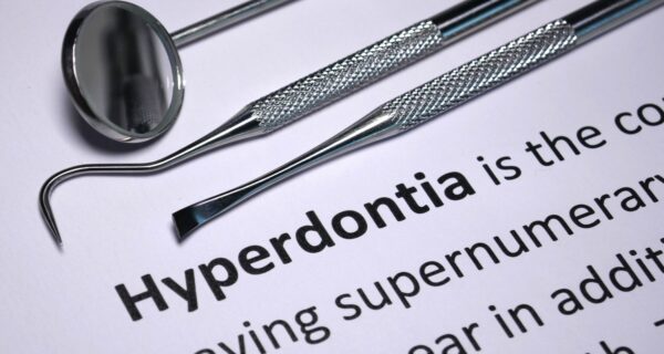 Hyperdontia | 9 Interesting Causes of Excess Number of Teeth