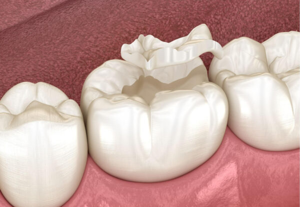 Tooth Filling Fell Out: 5 Important Reasons to see a Dentist