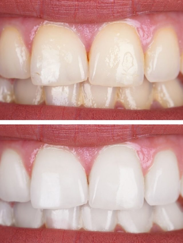 Understanding the 2 Primary Causes of Blue or Gray Teeth