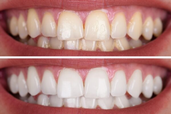 Blue or Gray Teeth: 2 Primary Causes You Should Know