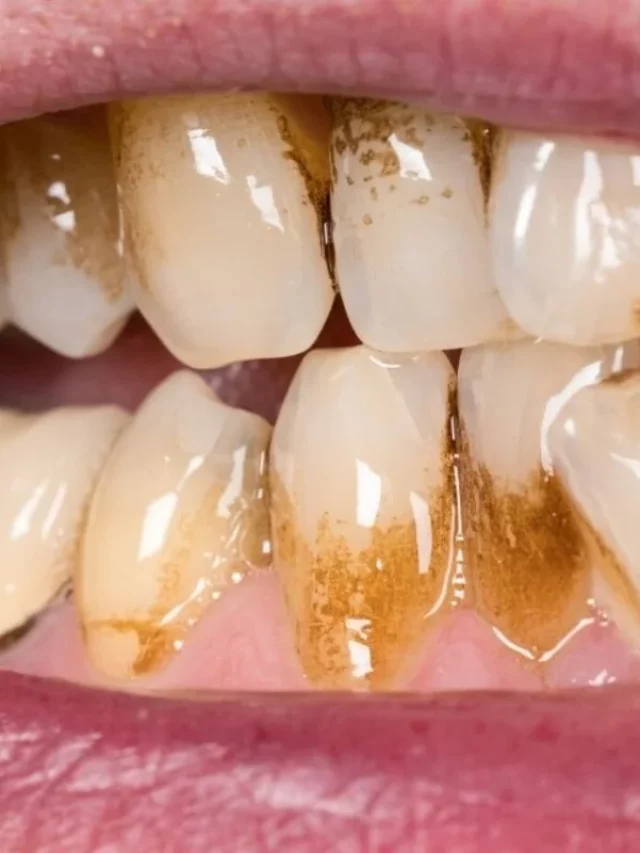 7 Critical Problems and Diseases to Prevent: Understanding What Is Tartar